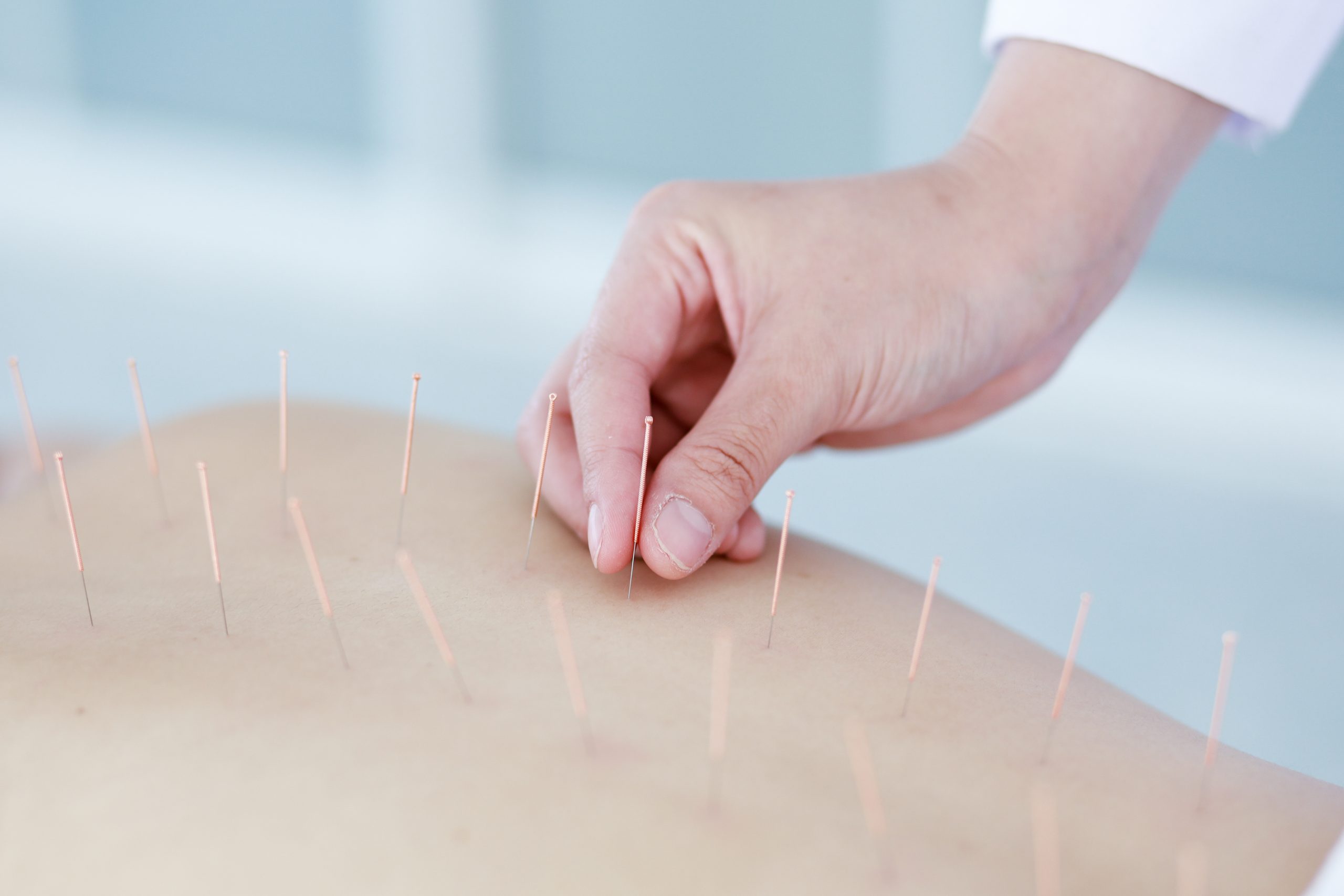 Combining Acupuncture with Western Medicine - Michigan Associates of ...